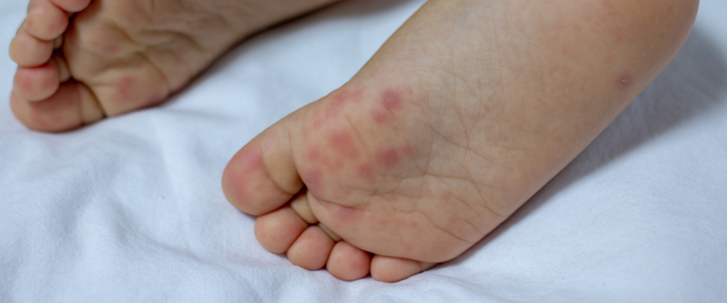 Infectious Diseases – Guidelines for Schools | HealthUnit Haldimand-Norfolk