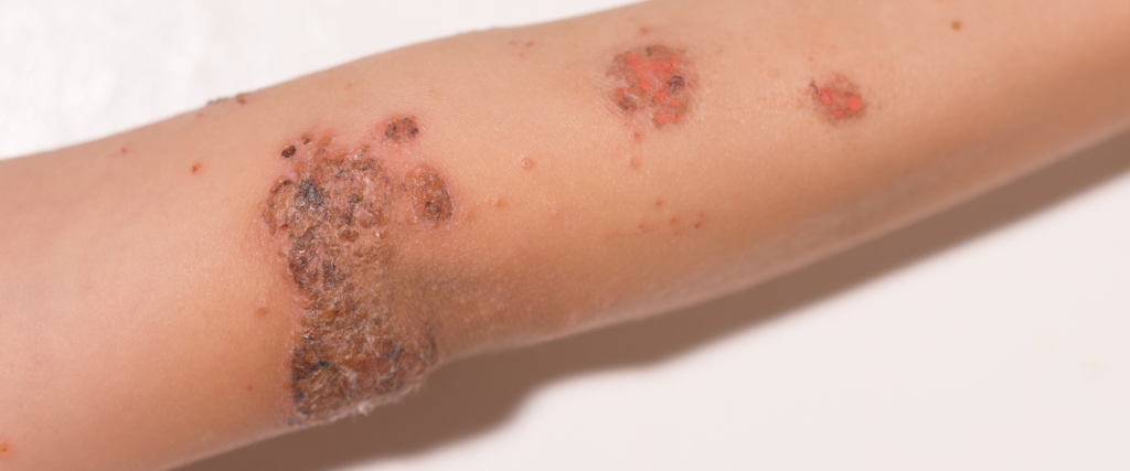 Infectious Diseases – Guidelines for Schools | HealthUnit Haldimand-Norfolk