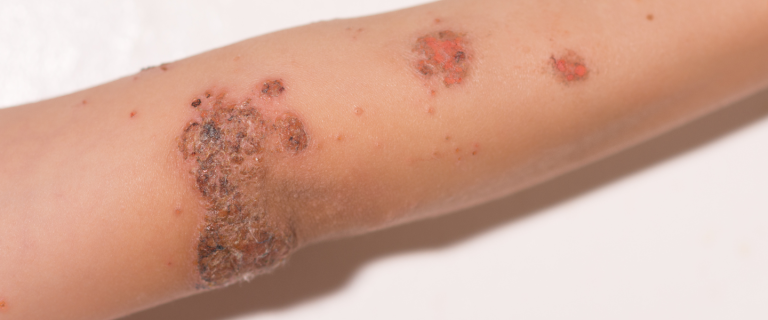 Infectious Diseases – Guidelines for Schools | HealthUnit Haldimand-Norfolk
